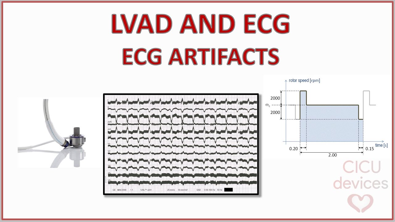 LVAD AND ECG - UNDERSTANDING ECG ARTIFACTS AND HOW TO MINIMIZE THEM ...