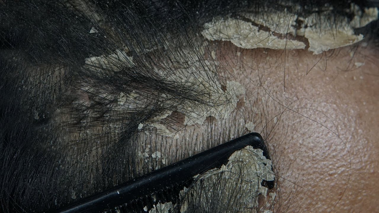 ASMR Satisfying Scalp Cleaning with Comb #DKMO308 - YouTube
