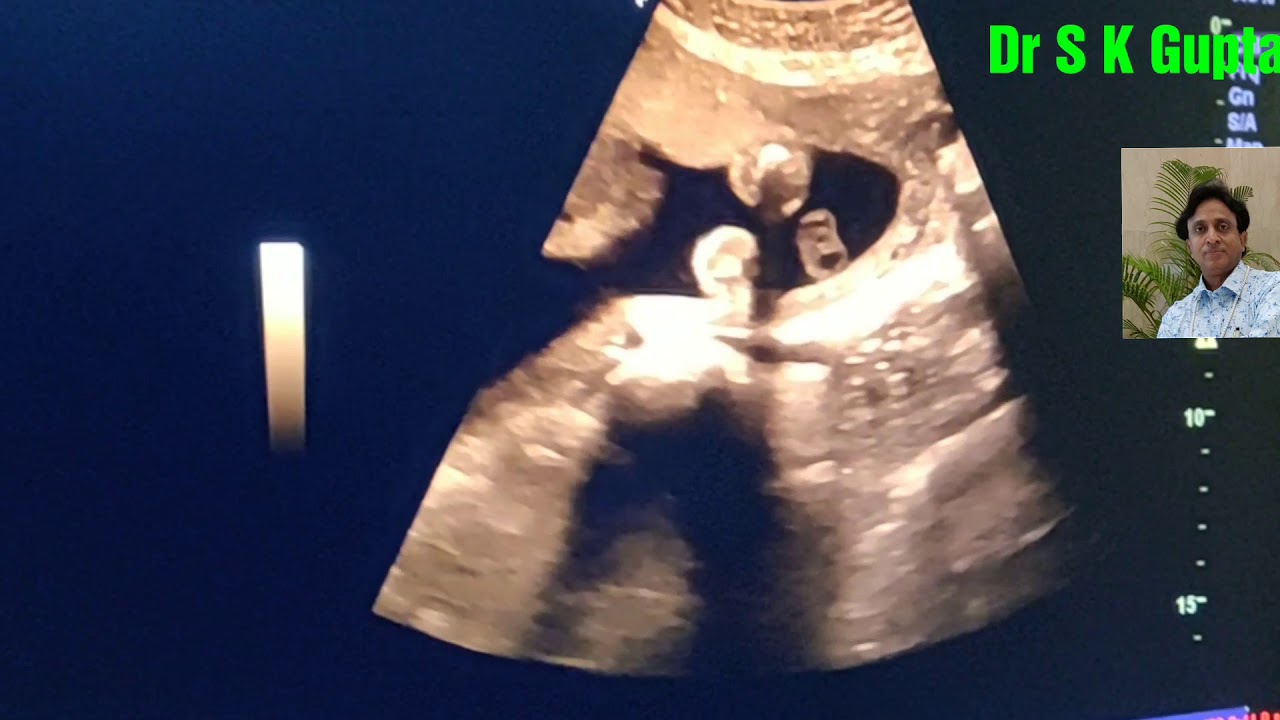 Level 2 scan (Case 2) in Pregnancy Anomaly scan how to do Ultrasound 20 ...