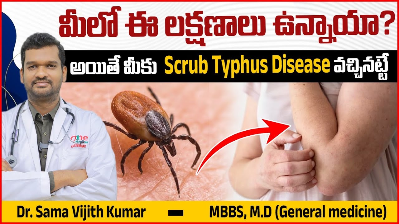 Scrub Typhus Disease Telugu || Scrub typhus Causes, Symptoms and ...