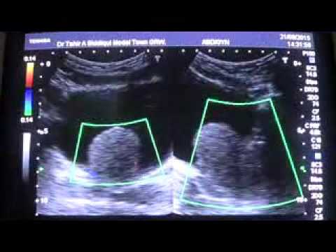 obstructive uropathy with bulbous cystitis BPH WITH ENLAEGED MEDIAN ...