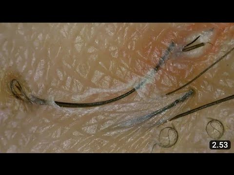cabut rambut gatal & tumbuh kedalam 5‼️(clear itchy ingrown hairs)# ...
