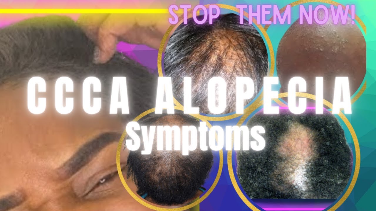 What Are The Symptoms of Central Centrifugal Cicatricial Alopecia (CCCA ...