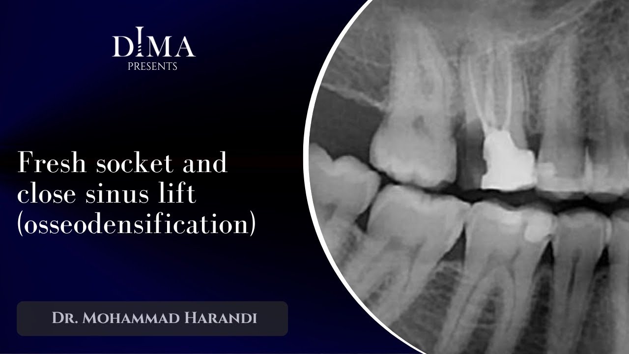 Fresh socket and close sinus lift ( osseodensification) ایمپلنت فوری ...