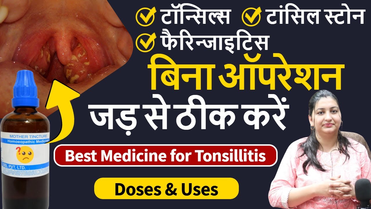 tonsillitis-best-medicine-for-tonsillitis