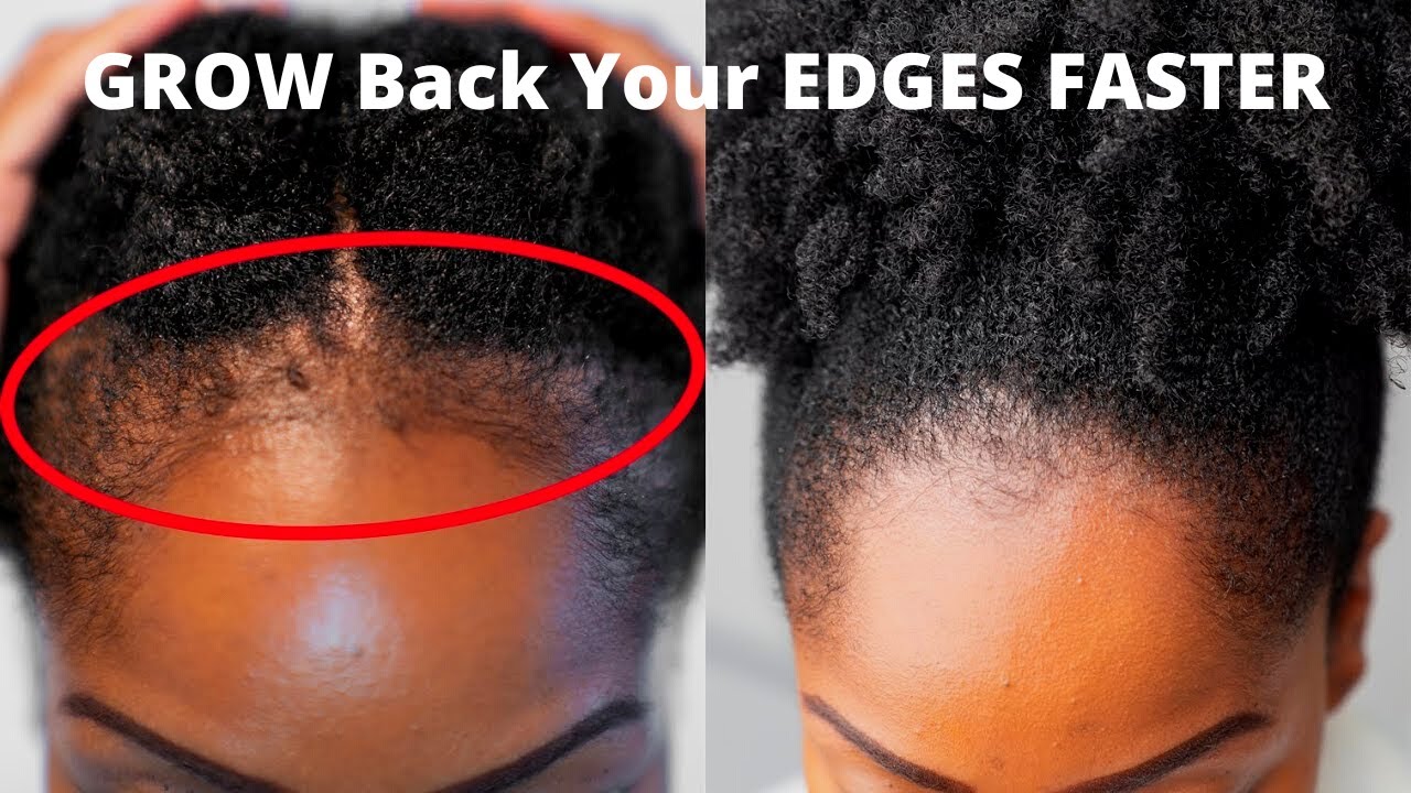 Regrow Your Edges and Bald Hair The Fast Way - YouTube