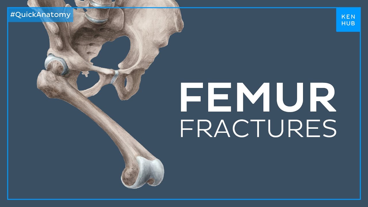 What happens when you fracture your femur - Quick Anatomy | Kenhub ...