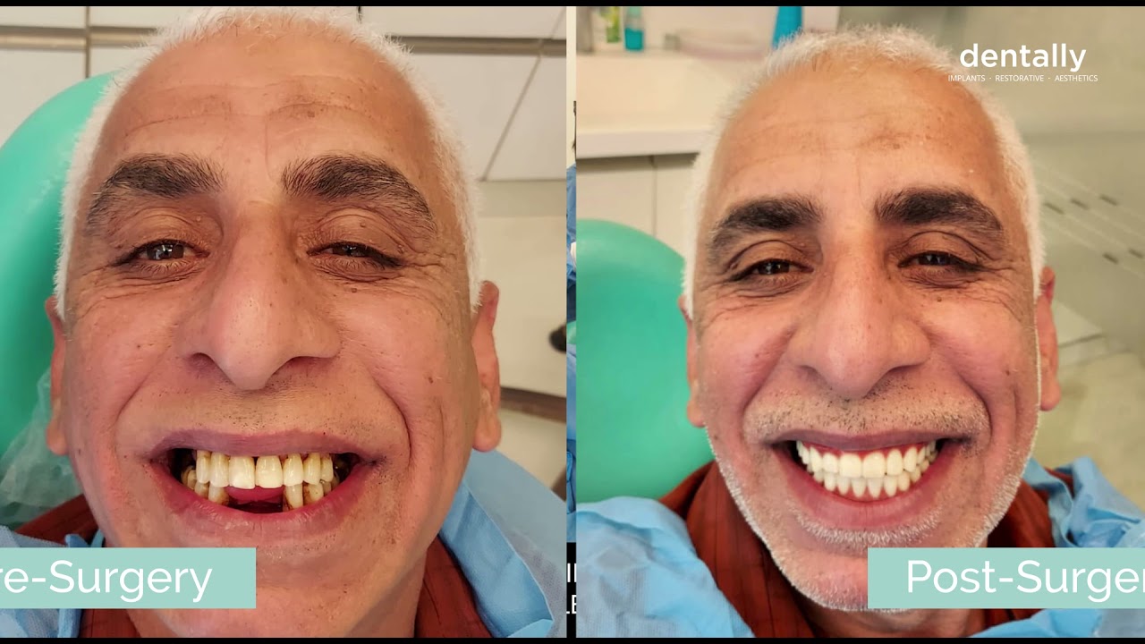 Full Mouth Replacement of Teeth with Dental Implants: Complete ...