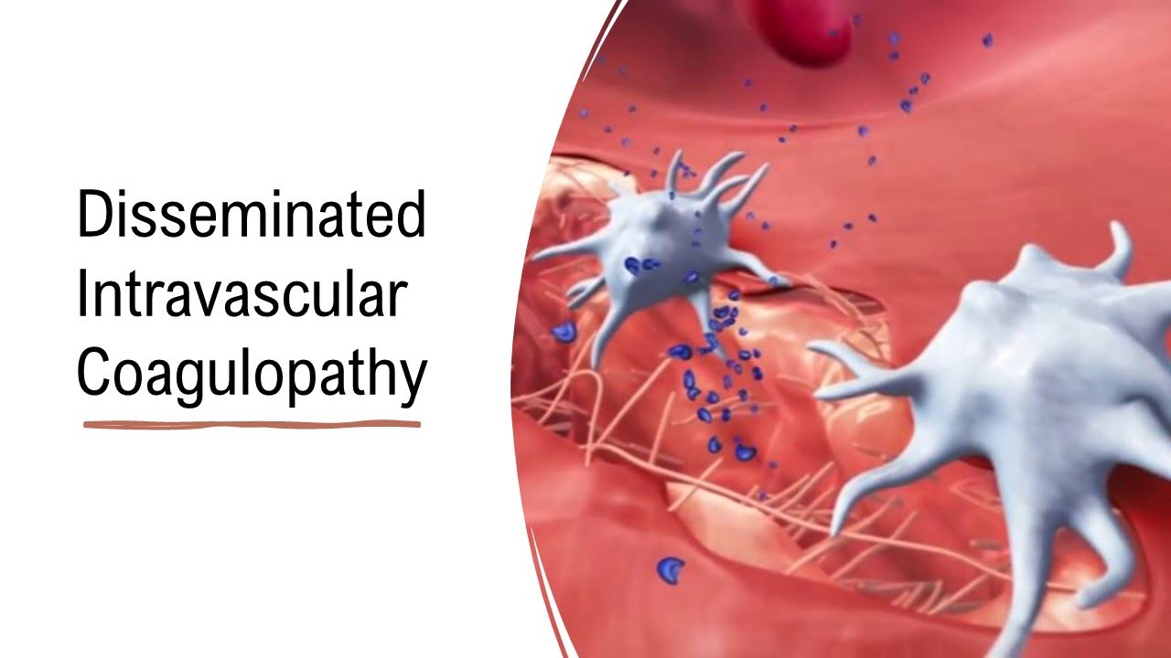 Disseminated Intravascular Coagulopathy (DIC) - YouTube