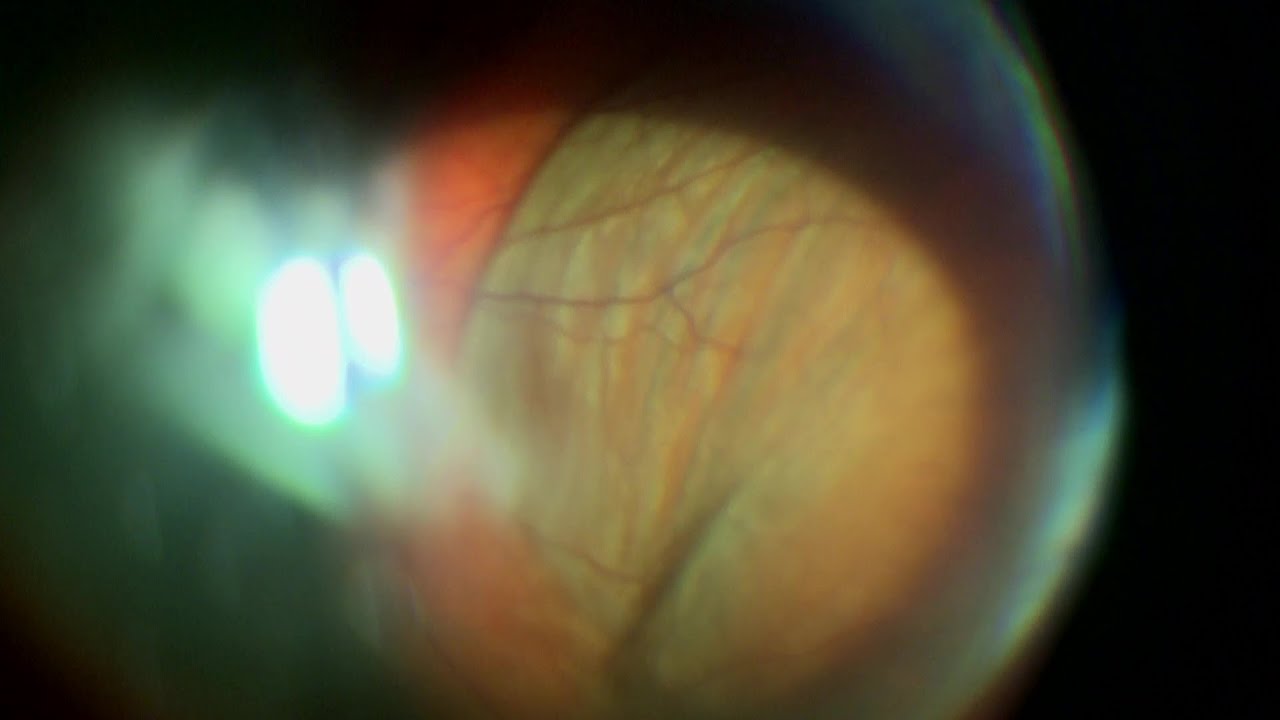 Aphakic eye with hypotony and wrinkly choroidal effusion - YouTube