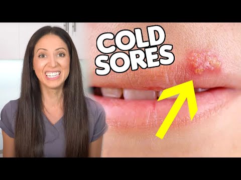 How To Get Rid Of Cold Sores Fast Diy