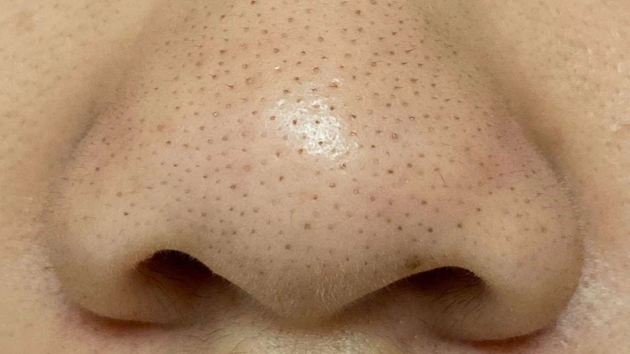 how to get rid of nose fat instantly - YouTube