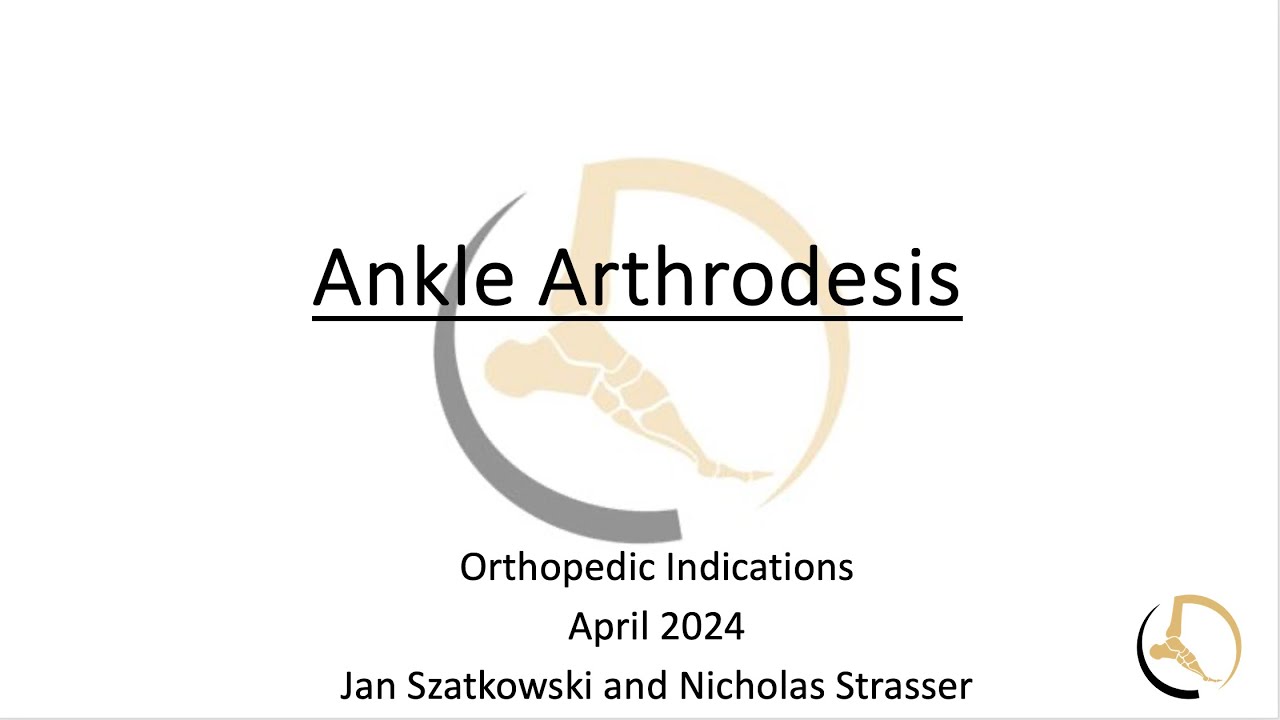 Tibiotalar fusion - posterior approach - YouTube