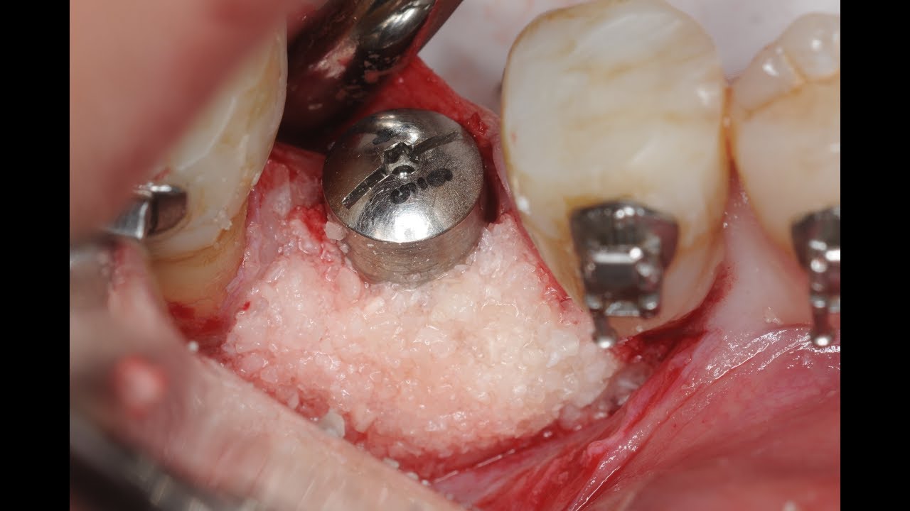The Tooth Transformer in Guided Bone Regeneration - YouTube