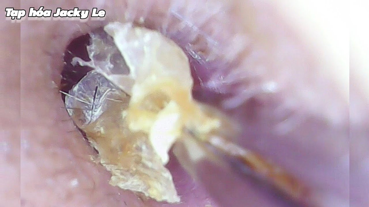 Ear Wax Removal #129: The earwax made him itchy so he couldn't sleep ...