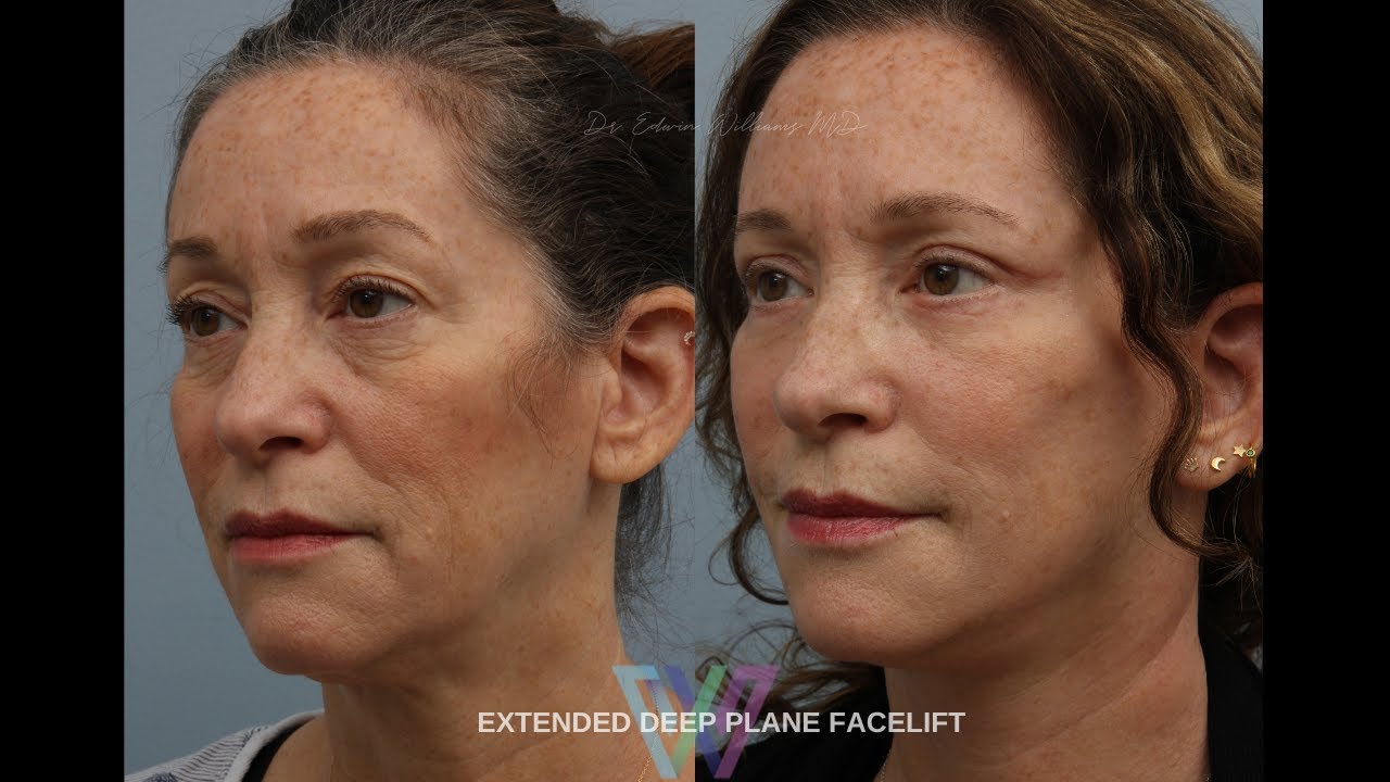 NYC Patient Travels Out of New York City for Deep Plane Facelift ...