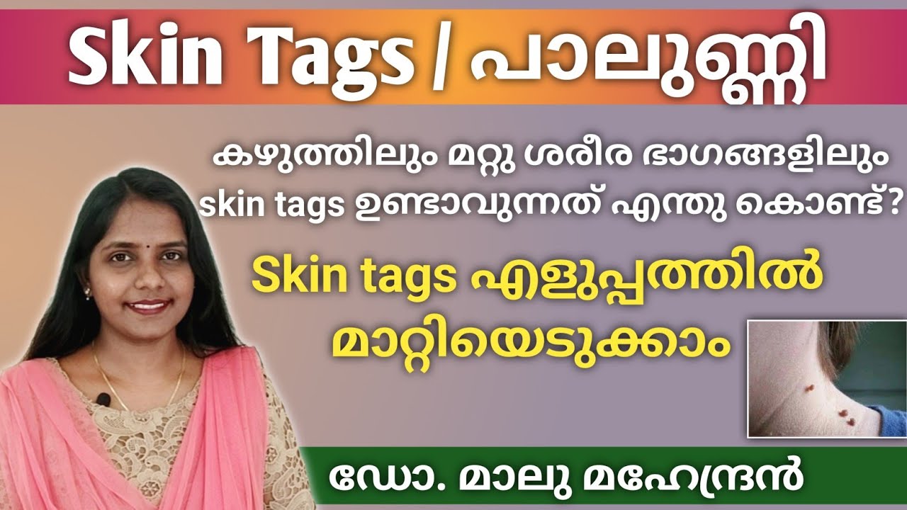 Skin tags Malayalam | Skin tag removal | Palunni removal malayalam ...