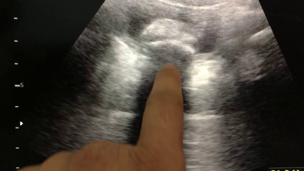 Urinary bladder calculi Ultrasound - YouTube