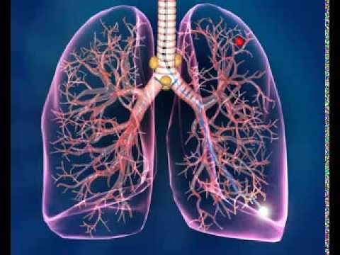Electromagnetic Navigation Bronchoscopy (ENB) Procedure - YouTube