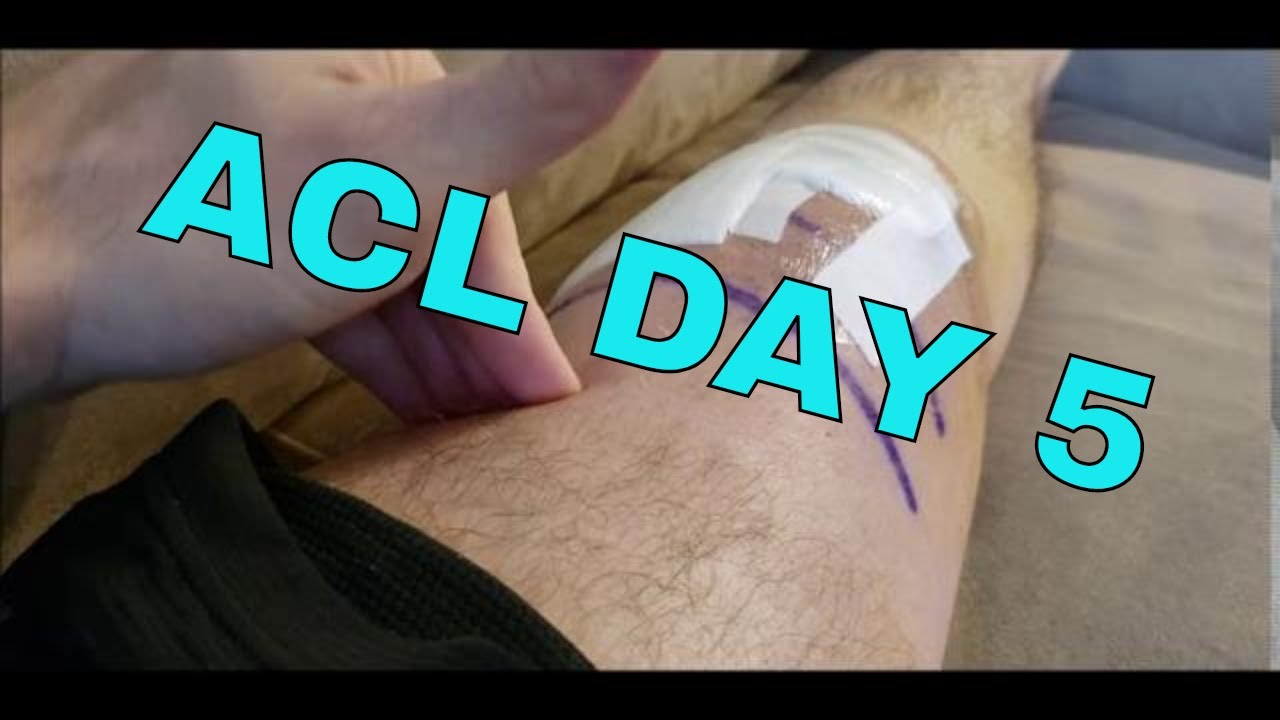 ACL Recovery - Day 5 (Ups and Downs) - YouTube