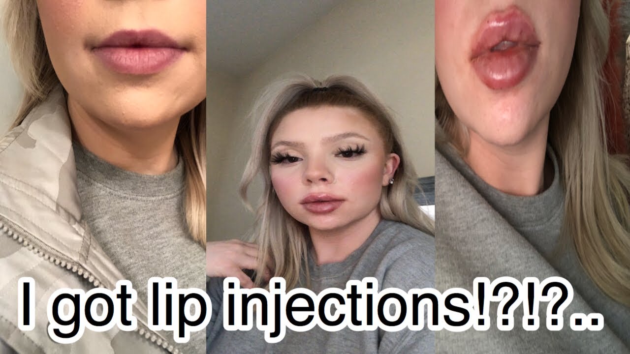 MY LIP INJECTION EXPERIENCE - YouTube
