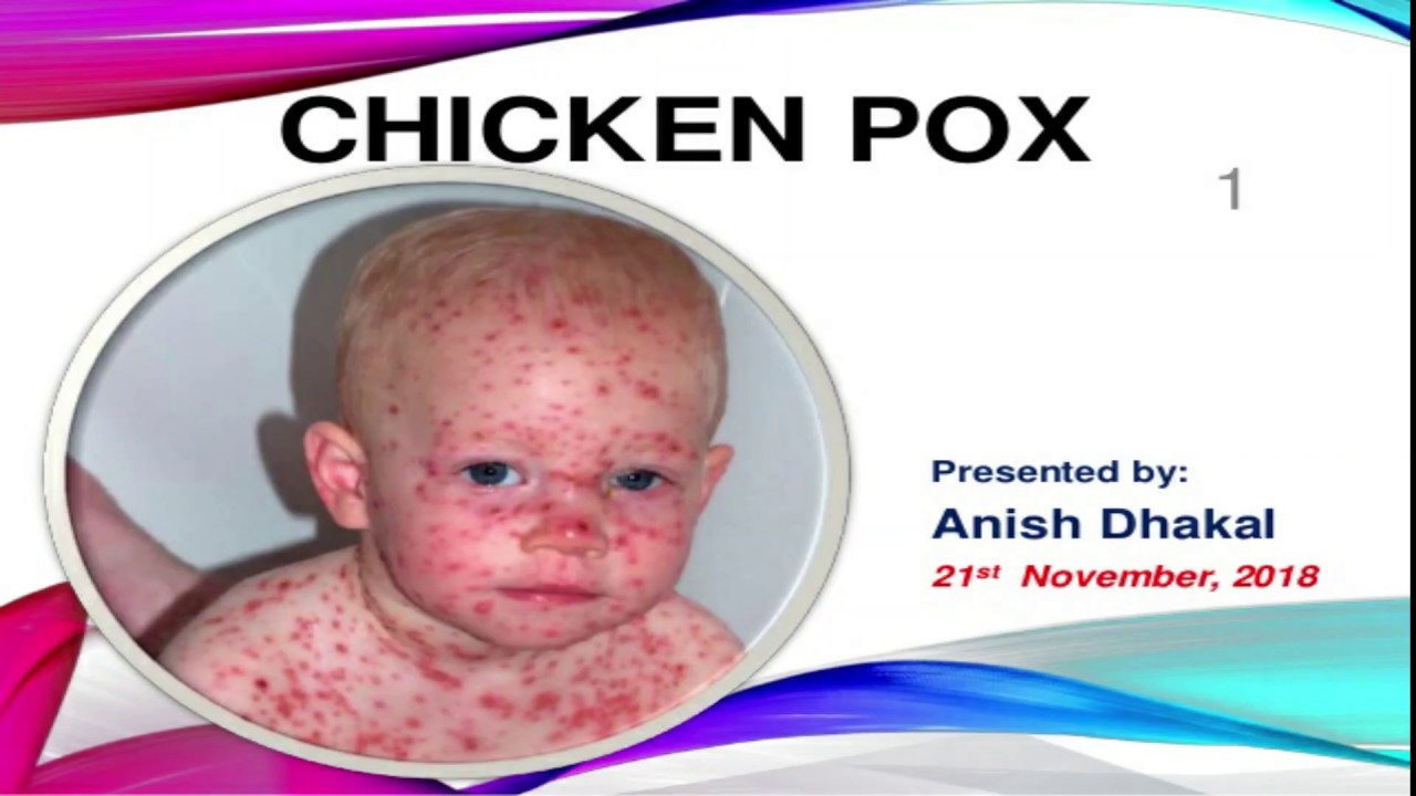 CHICKEN POX: MED IN A MINUTE: D&N Medical Series - YouTube