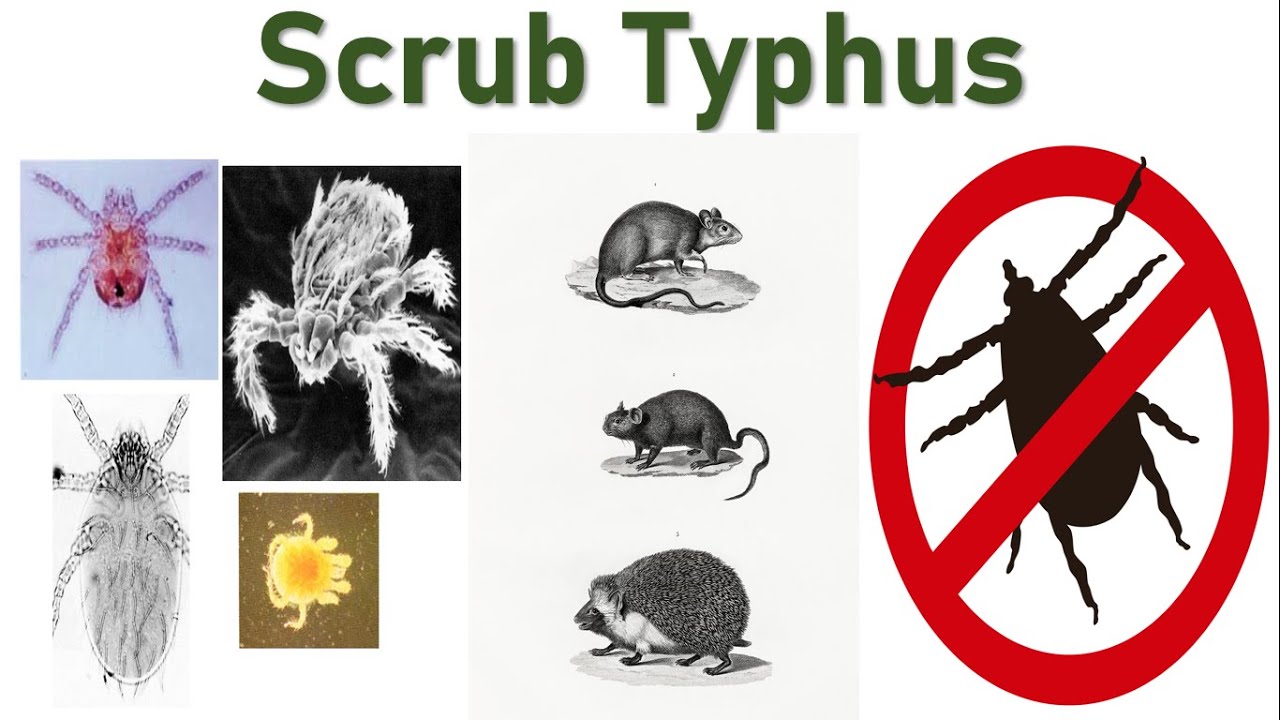 Scrub Typhus: A Chigger-Borne Disease | Rickettsial Fever | Chigger ...