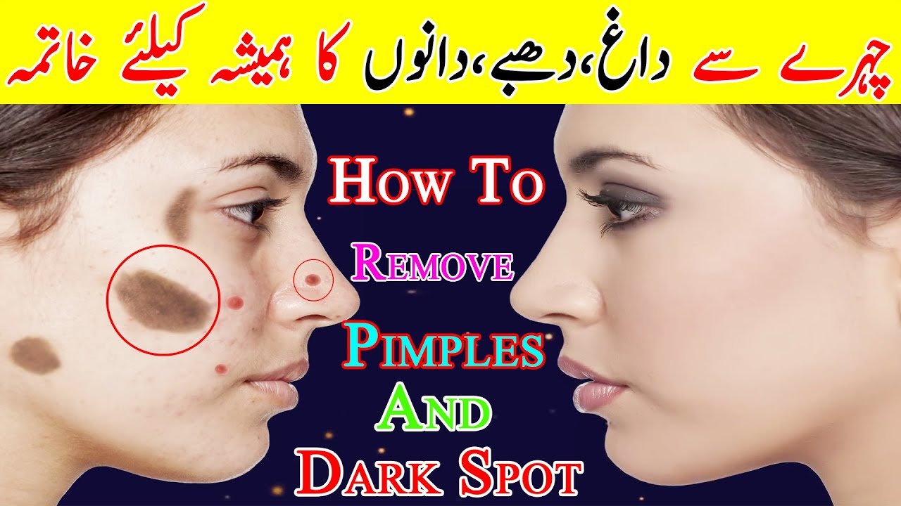 How To Remove Pimple In Urdu / Chehry Ky Dagh Dhaby Khatam Karny Ka ...