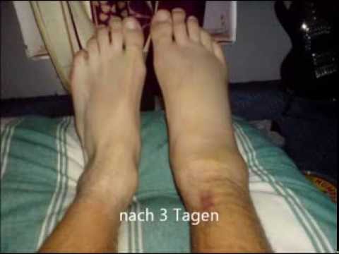 Bänderriss - YouTube