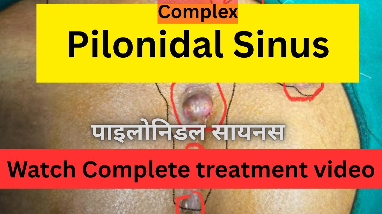 Pilonidal Sinus Laser Treatment in Nashik | 3 Years Recurrence-Free ...