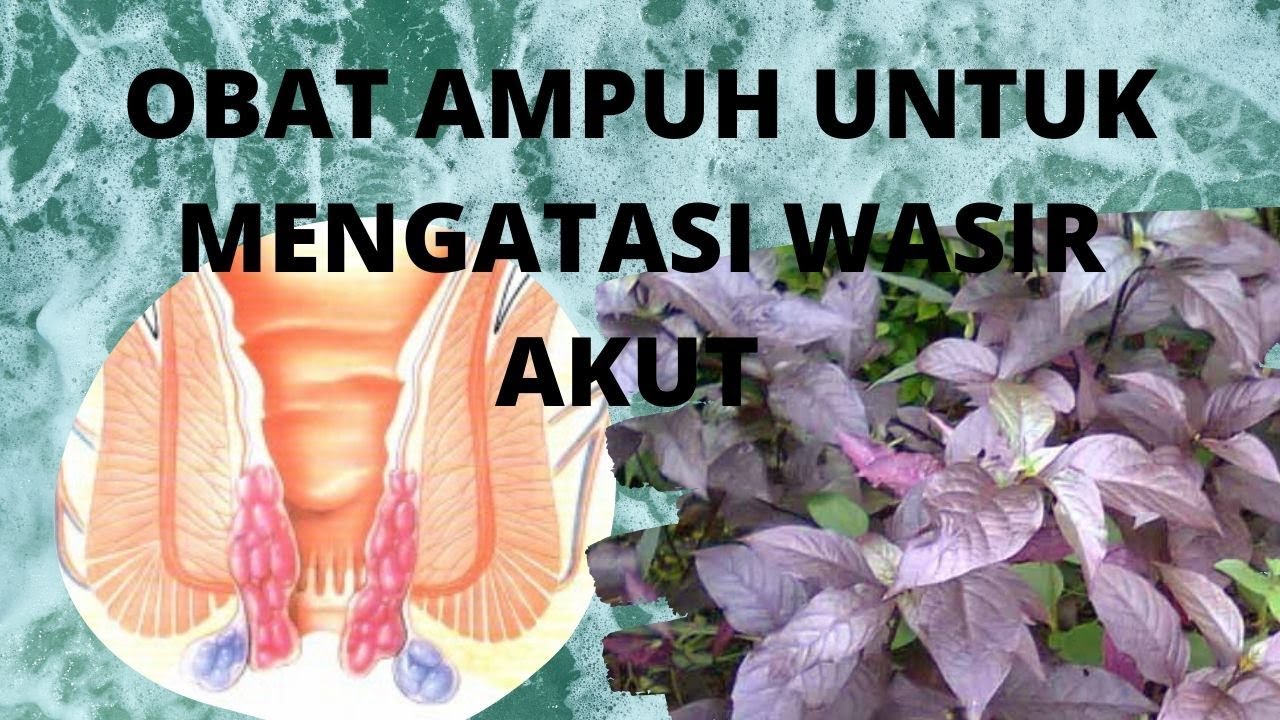 OBAT AMPUH UNTUK MENGATASI WASIR AKUT - YouTube