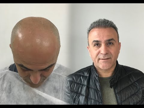 Kayseri Saç Ekimi... 11 saatlik bir emek ve aşırı mutluluk içerir