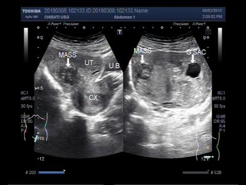 Ultrasound Video showing an incomplete abortion with a uterine mass ...