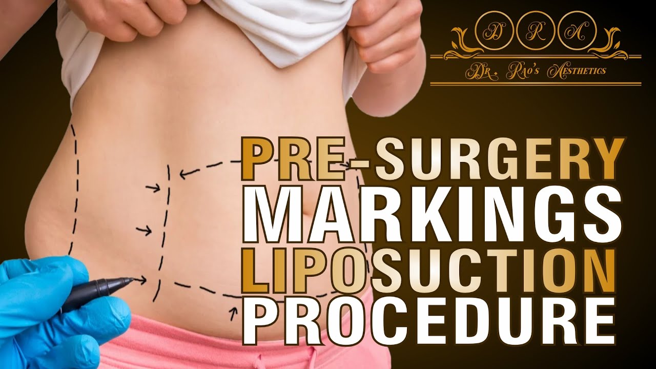 Liposuction Prep: The Importance of Pre-Surgery Markings - YouTube