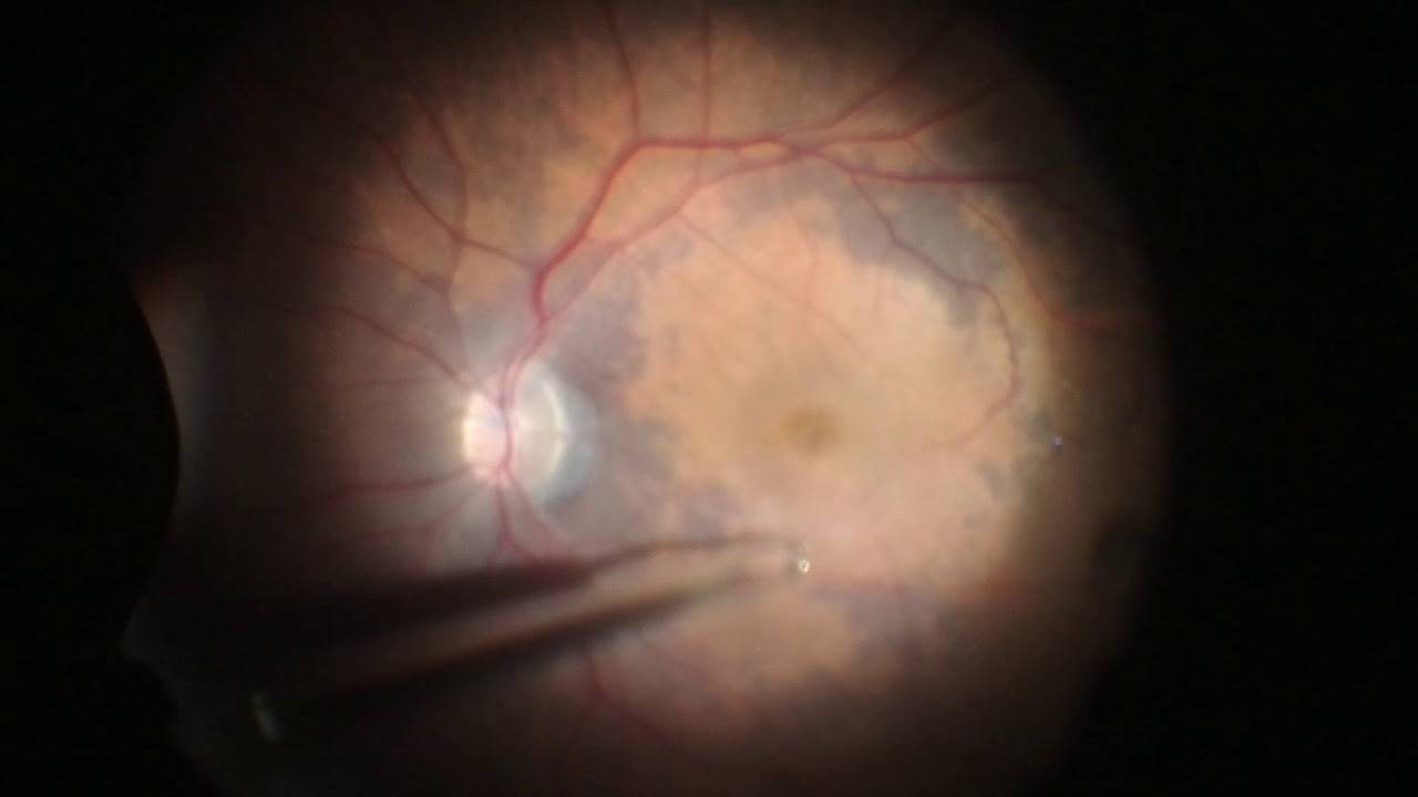 Epiretinal membrane peeling - YouTube