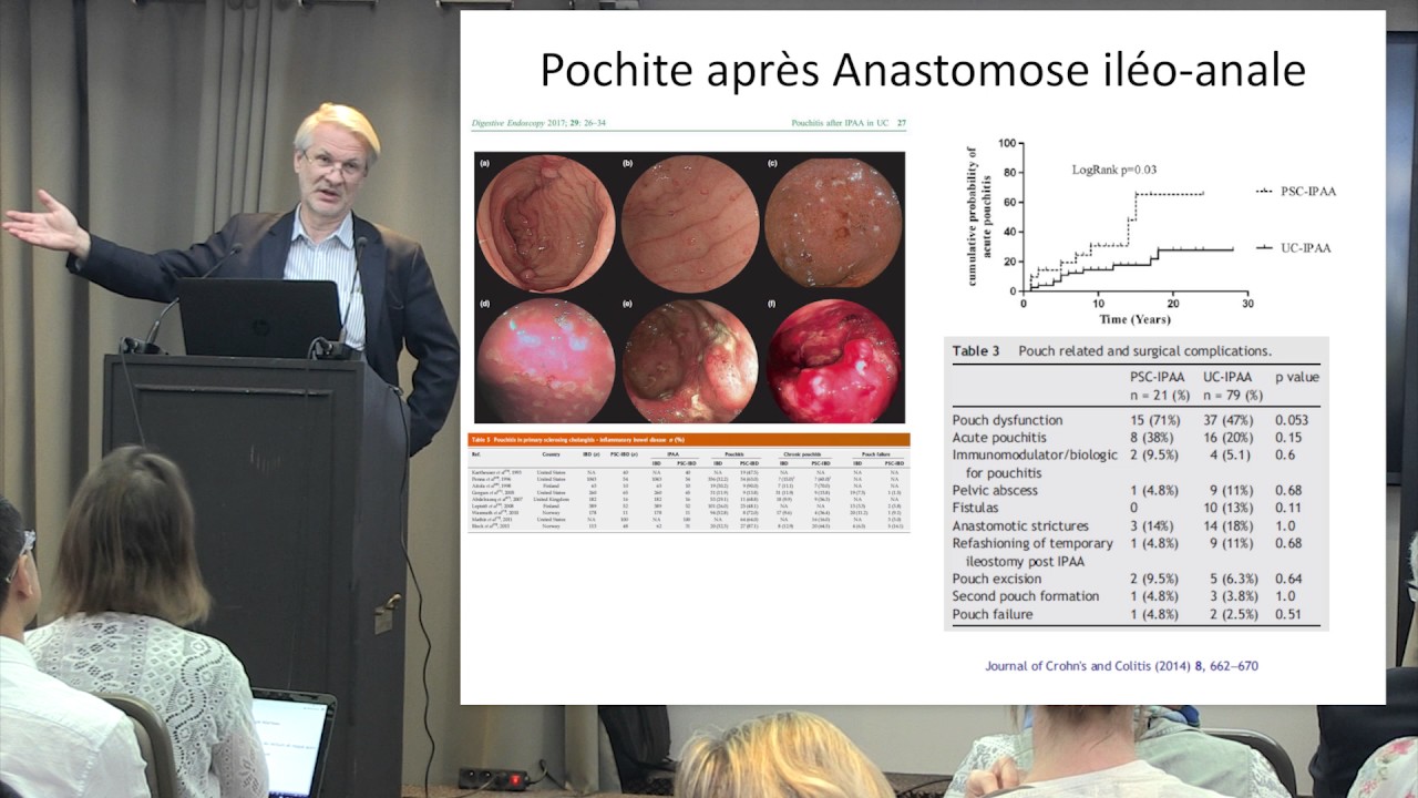 Les colites inflammatoires associées à la CSP - YouTube