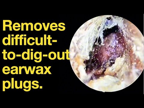 Removes difficult-to-dig-out earwax plugs.|ear wax removal | ear ...