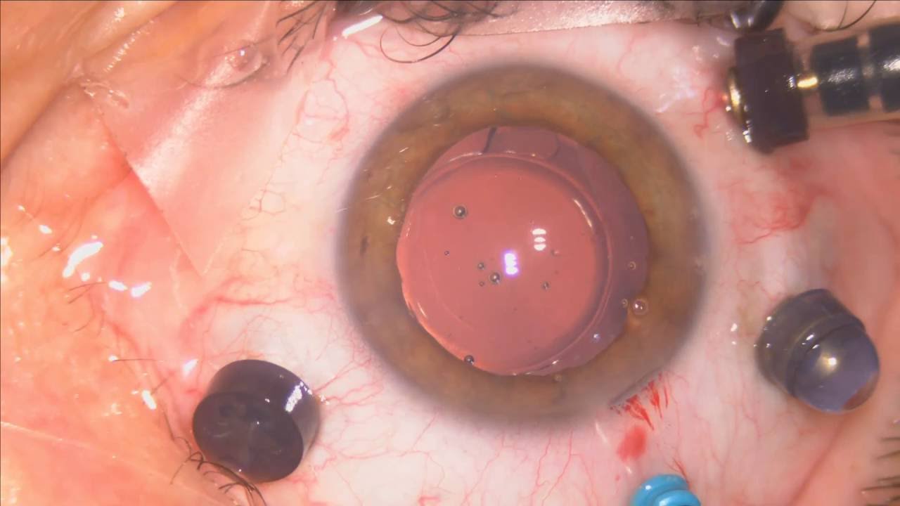 Alcon Finesse flex loop ,macular hole Lukan Mishev Live Stream - YouTube