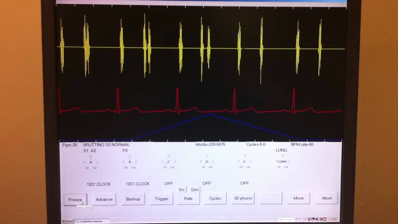 Normal S2 Splitting - YouTube