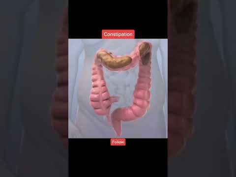constipation animation #health #bodyinsight - YouTube