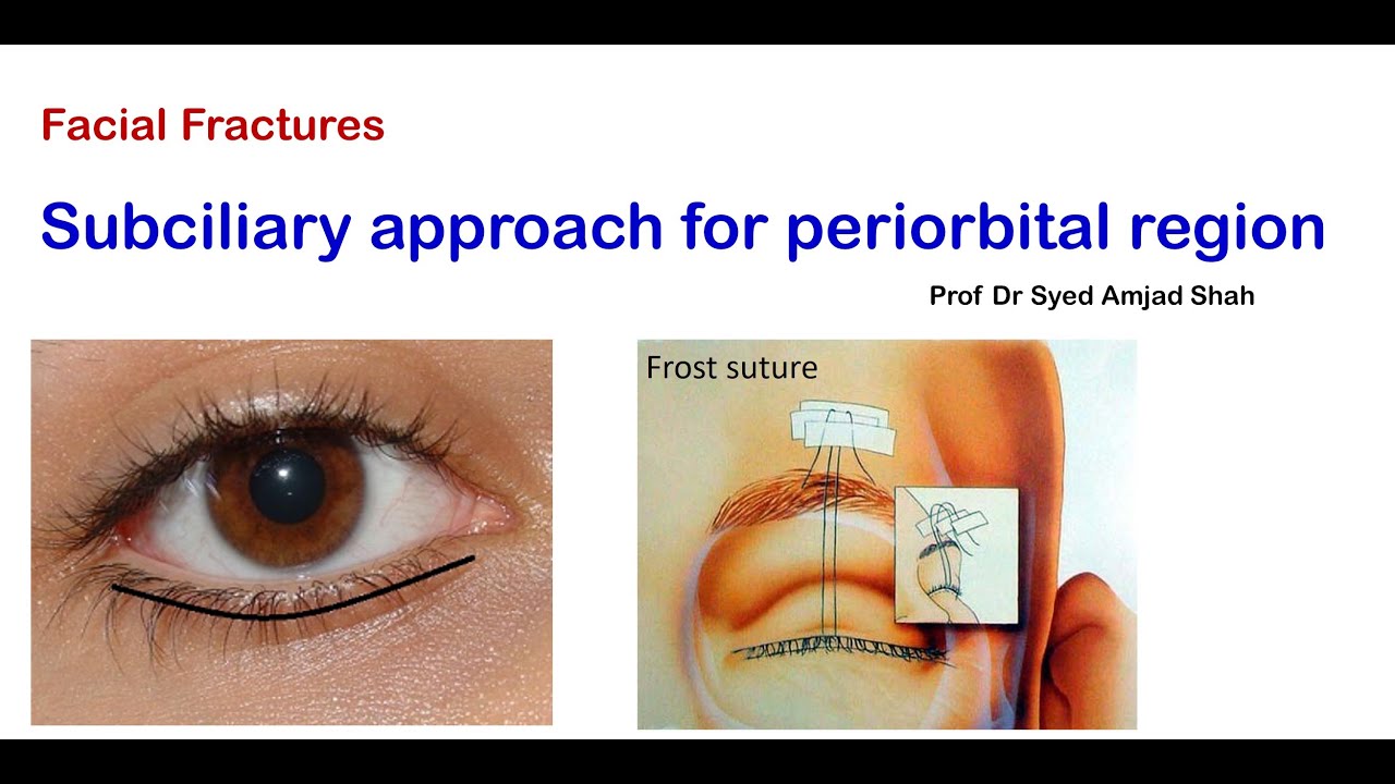 Subciliary approach for Periorbital region | English | Oral ...