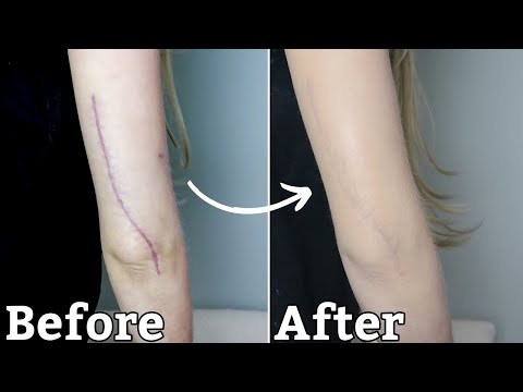 How To Cover/Conceal A Surgical Scar
