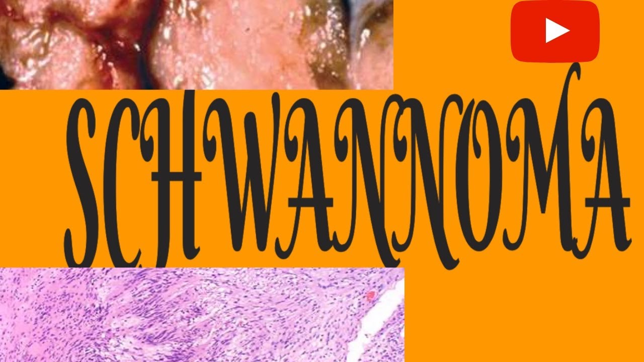 Schwannoma(Neurilemmoma)What are the symptoms and what causes ...