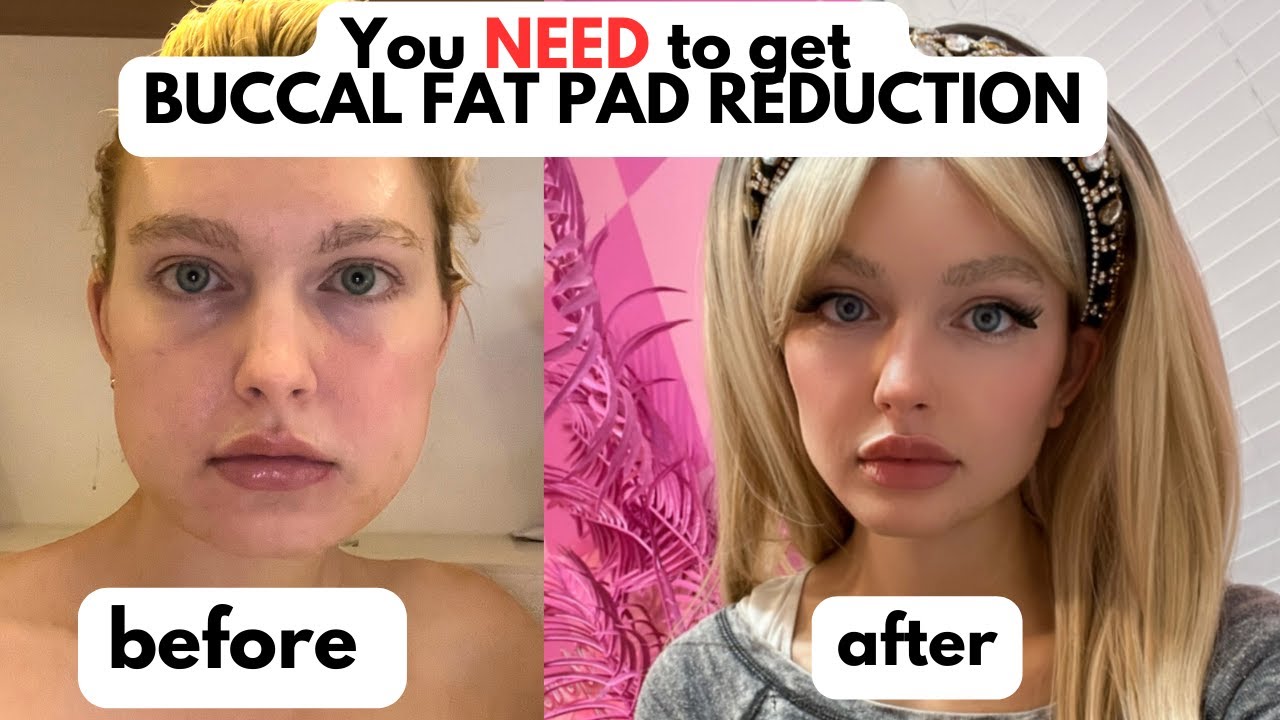 You NEED buccal fat pad reduction!!! MY EXPERIENCE + ONE YEAR AFTER ...