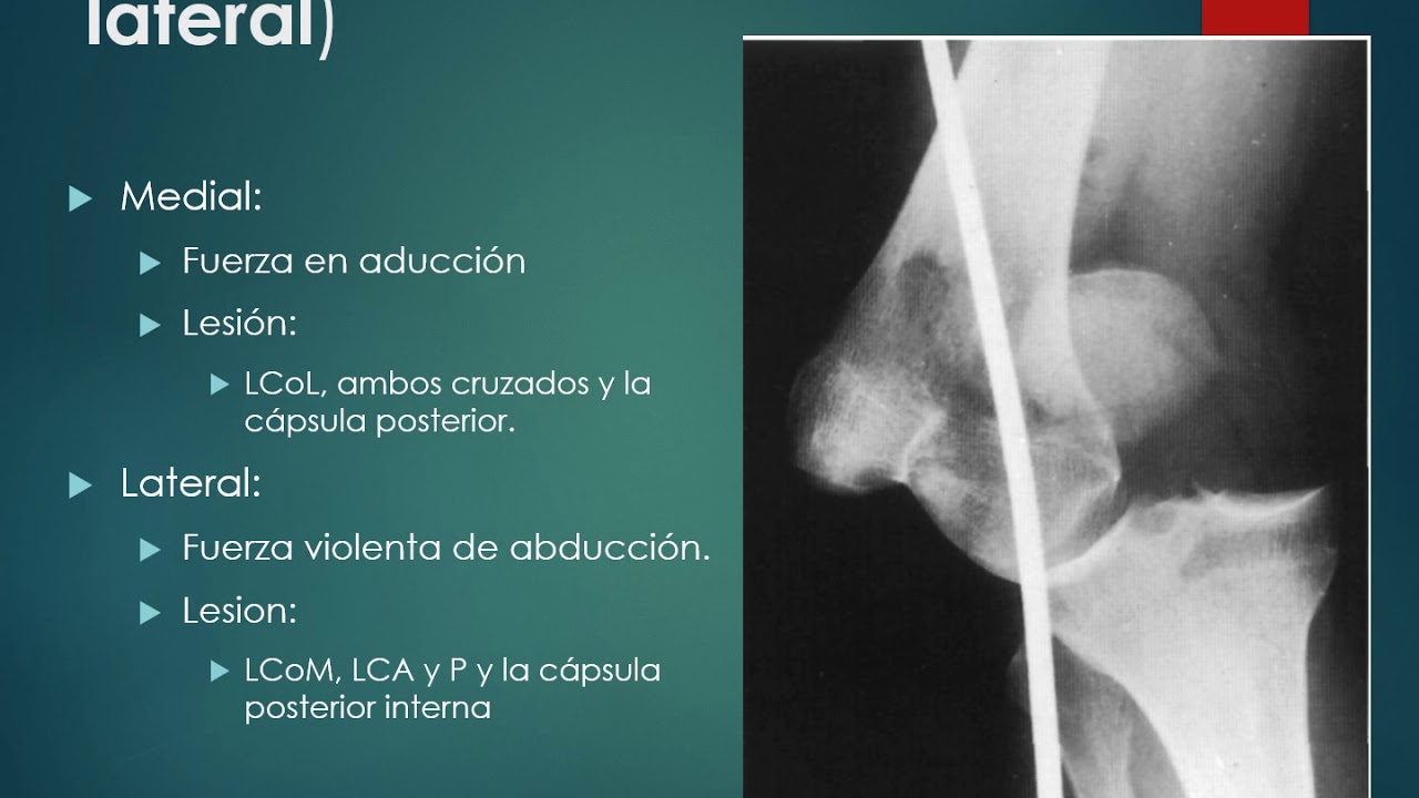 CLASE VIDEO LUXACIÓN DE RODILLA Traumatologia Guayaquil Artroscopista ...