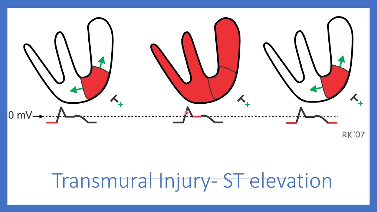 EKG #5 - Anterolateral STEMI - YouTube