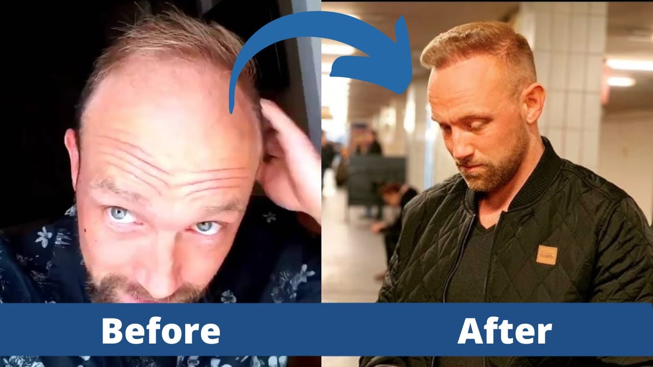 Second Hair Transplant Before and After - Month by Month results from ...