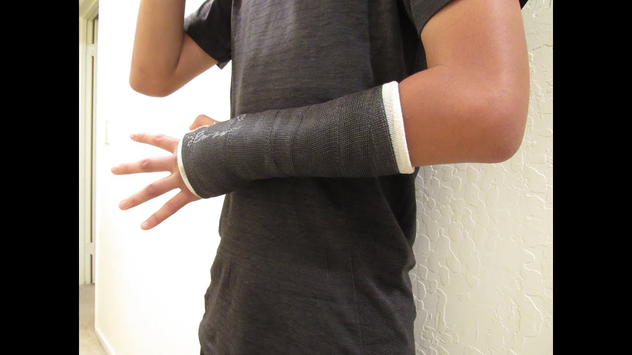 Broken Arm Didn't Stop This Boy from Playing Fortnite! - YouTube