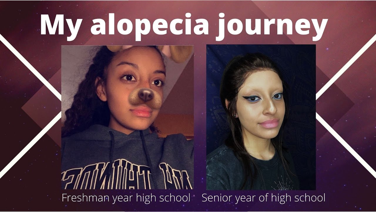My alopecia journey - YouTube