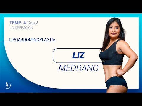 Lipoabdominoplastia - Liz | CAMBIOS